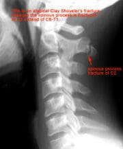What is a Clay-Shoveler's Fracture? - El Paso, TX Doctor Of ...