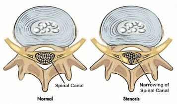 Spinal Stenosis Symptoms Early Diagnosis and Treatment