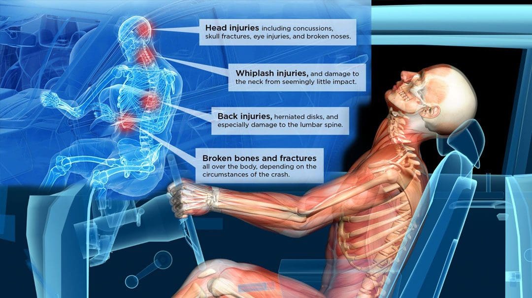Rear End Collision Injuries EP s Chiropractic Rehabilitation Team Rear End Collision Injuries EP s Chiropractic Rehabilitation Team